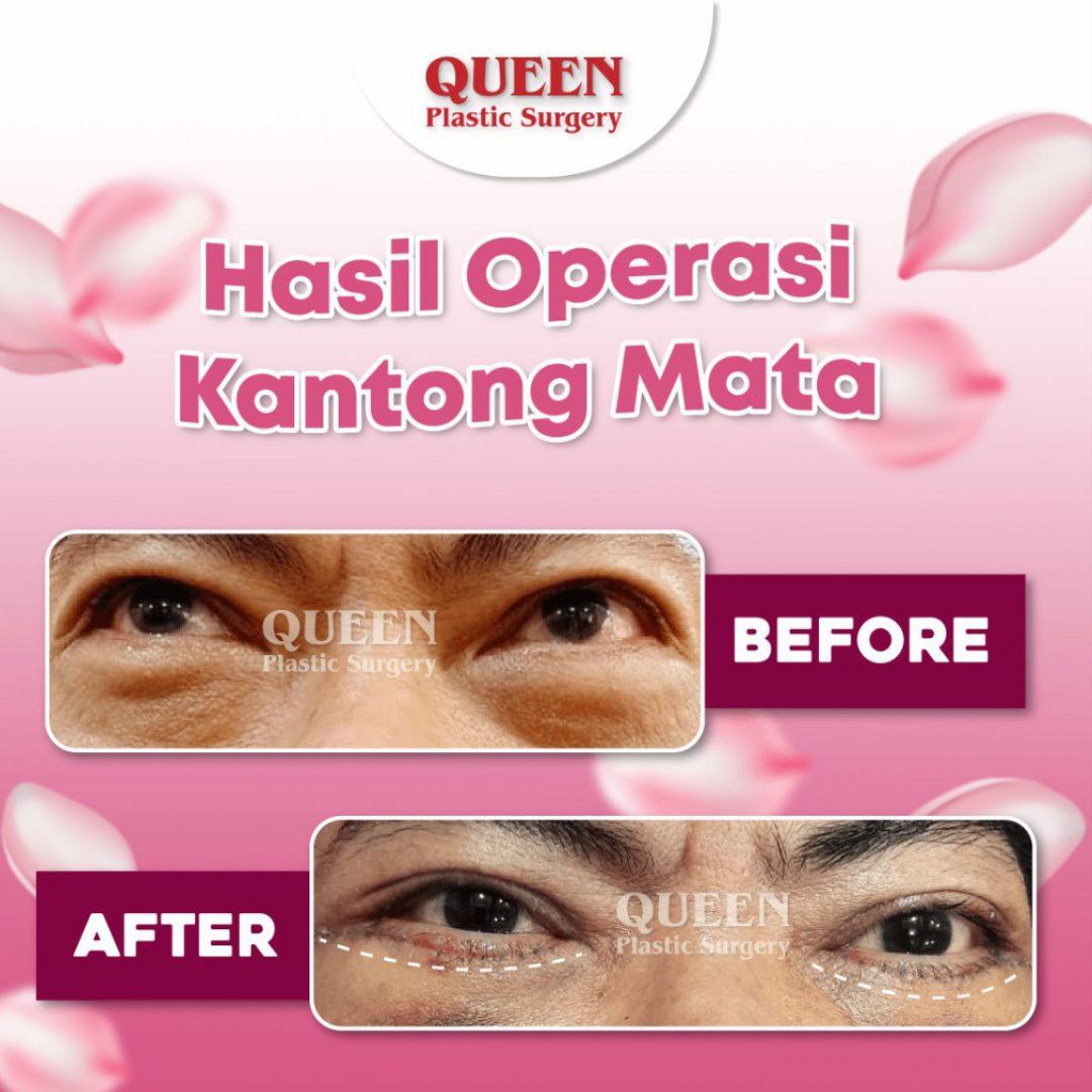 Operasi Kantung Mata Terbaik di Jakarta - Queen Klinik Kecantikan