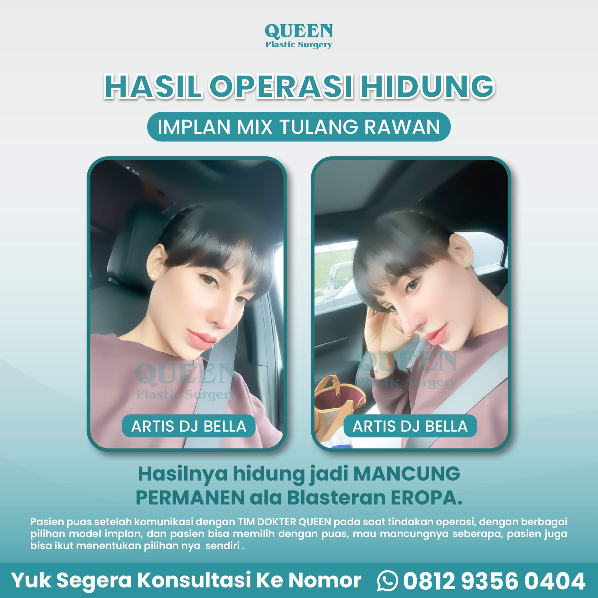 Jenis Operasi Hidung yang Perlu Diketahui di Queen Plastic Surgery ...